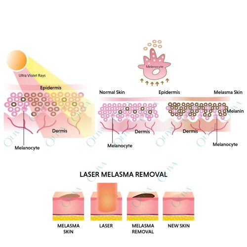 Melasma Treatment – Purple Face